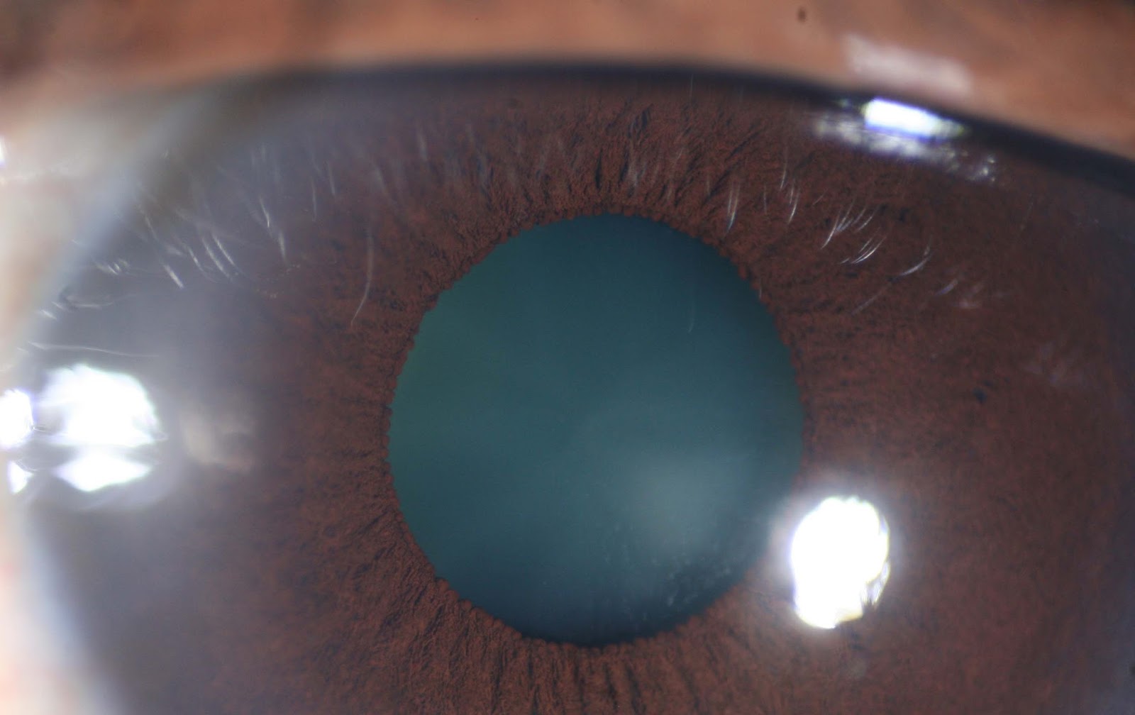 Modern & Multidimensional Iridology: Iris Sign On Hematogenic Iris ...