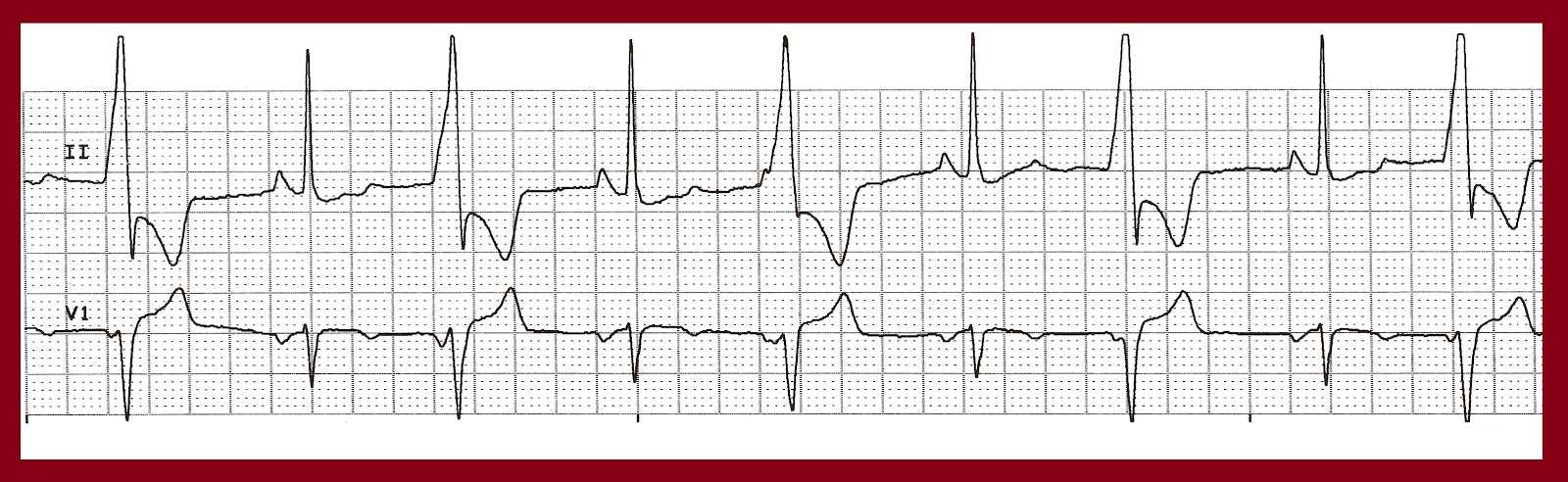 Various Bigeminal PVCs
