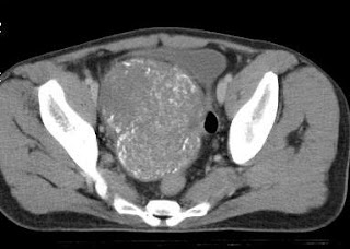 Cryptorchid Testis & Germ Cell Tumour-CT - Sumer's Radiology Blog