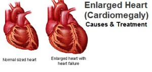 Diseases & Condition-What is Heart Enlargement (Cardiomegaly) | Health ...