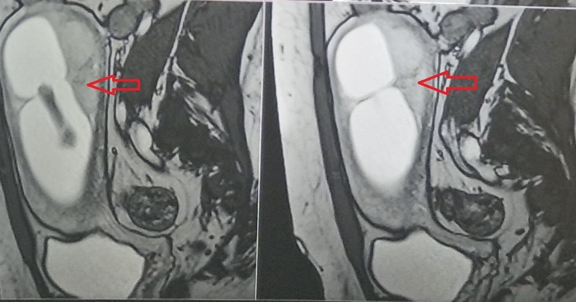 Journal Of Postgraduate Gynecology Obstetrics Pregnancy Outcome With Journal Of Postgraduate Gynecology Obstetrics Pregnancy Outcome With