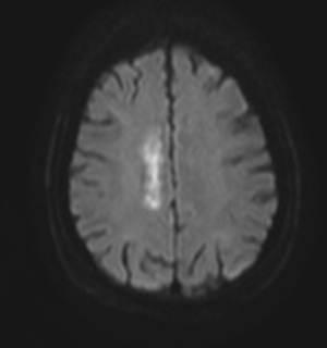 Corpus Callosum Infarction-MRI - Sumer's Radiology Blog