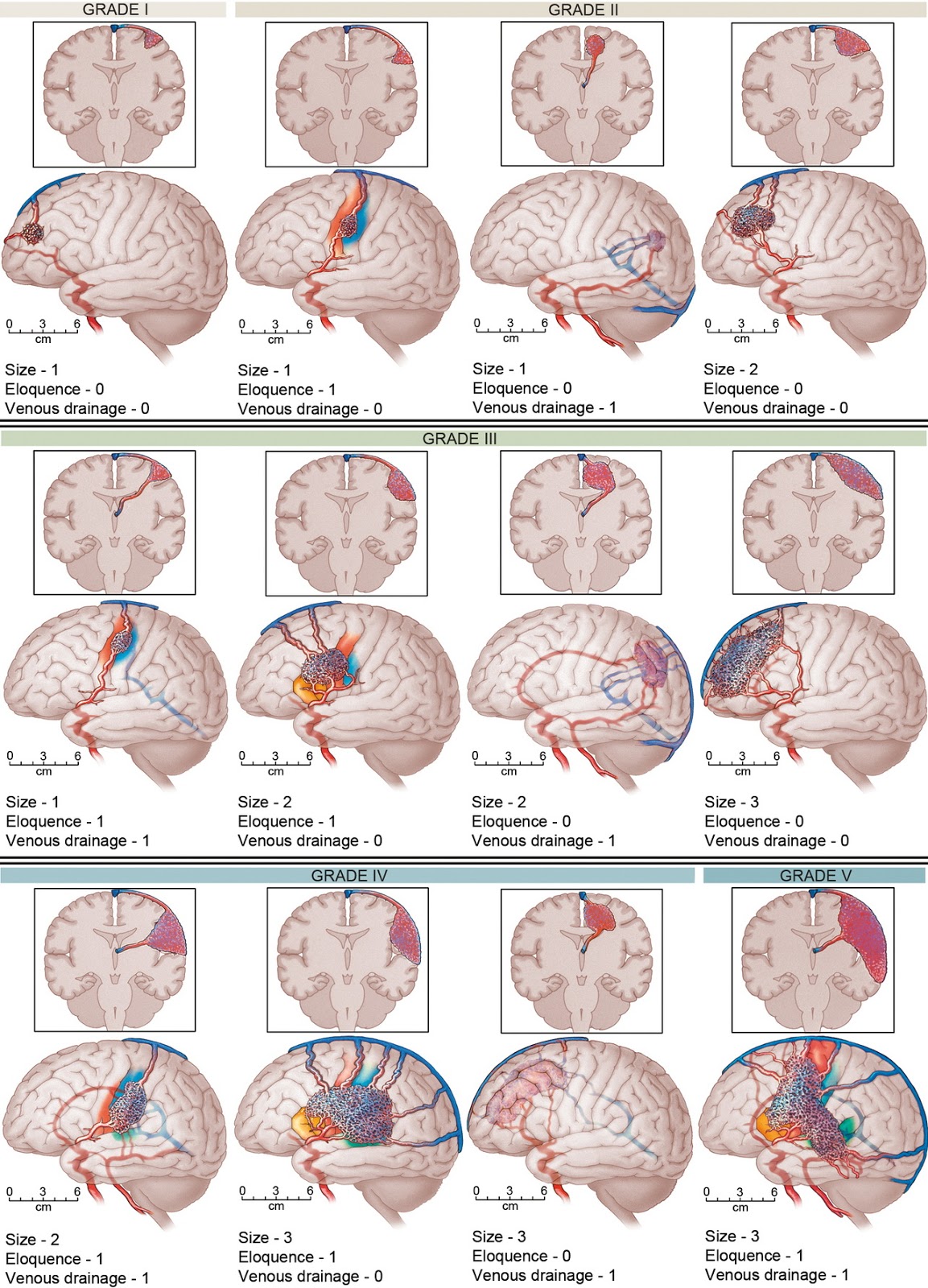 Radiology Archives: Αρτηριοφλεβώδης Δυσπλασία Εγκεφάλου (Spetzler ...