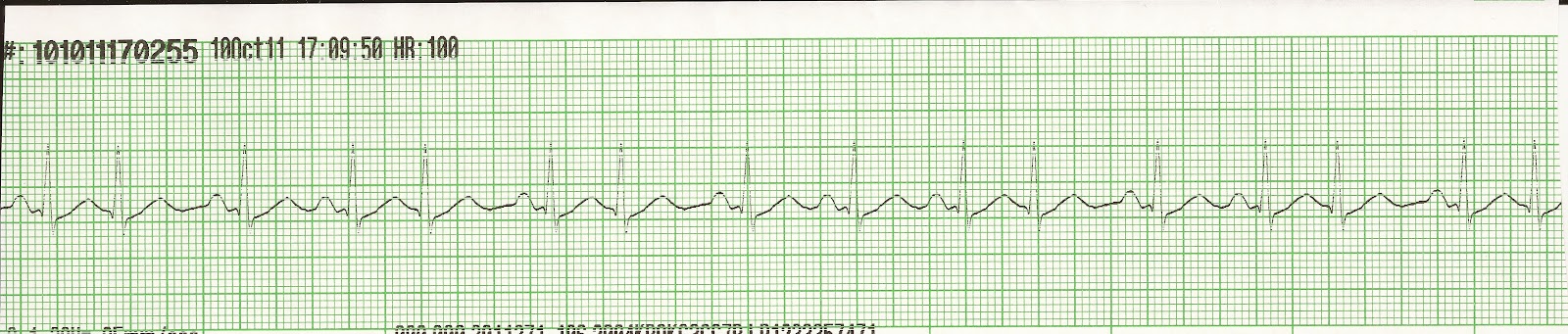 EKG Rhythm Strip Quiz 18