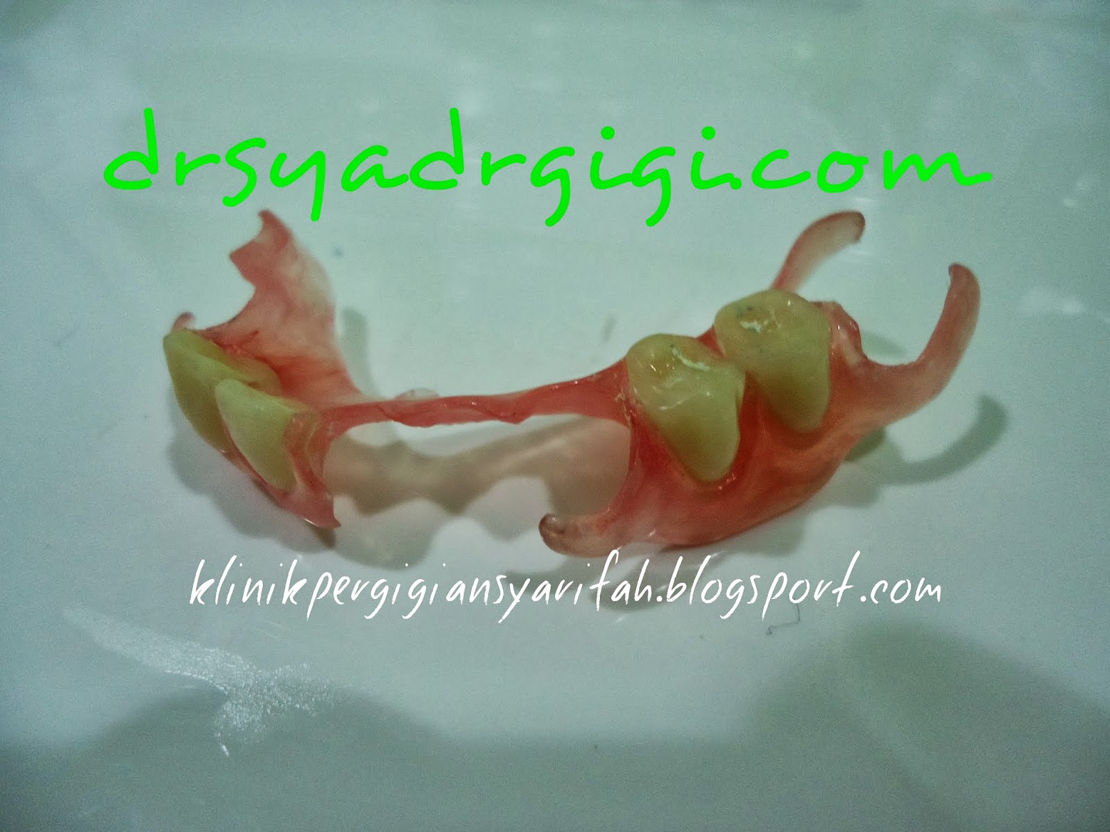 KLINIK PERGIGIAN SYARIFAH: GIGI PALSU FLEXIBLE vs GIGI PALSU COBALT CROME