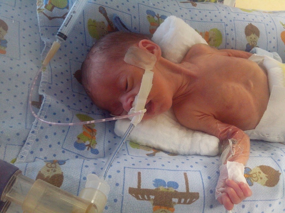 Mãe de Prematuro: Último Dia Entubado