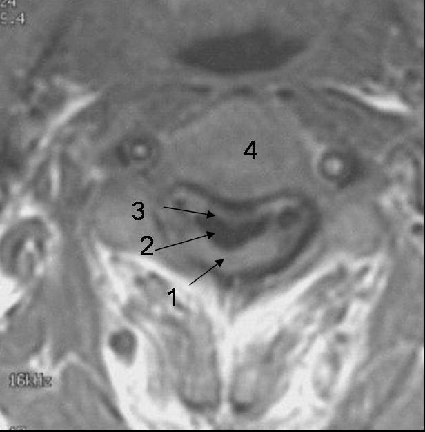 MRI MEDIC CASE STUDIES COLLECTION: Ossification of the posterior ...
