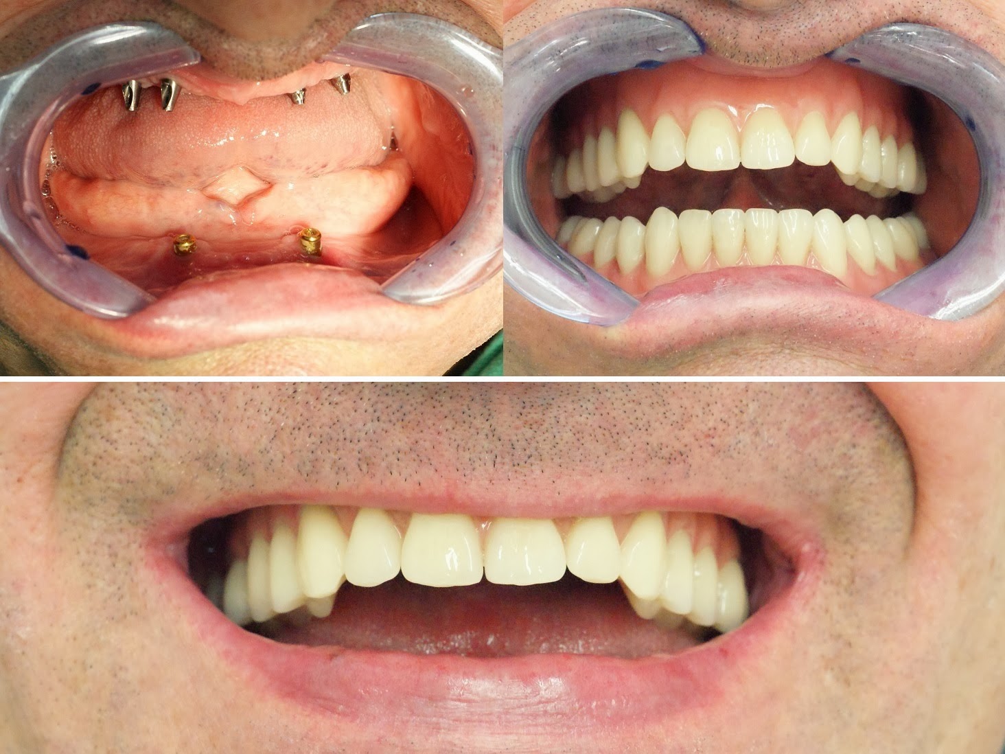 Zubni Implantati - Dentalni Implantati