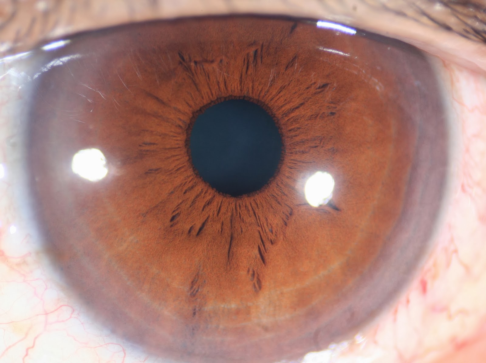 Modern & Multidimensional Iridology: IPB Morphologies, Space risk, IPB ...