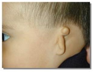 Mikrotia dan Atresia Liang Telinga - Catatan Mahasiswa FK