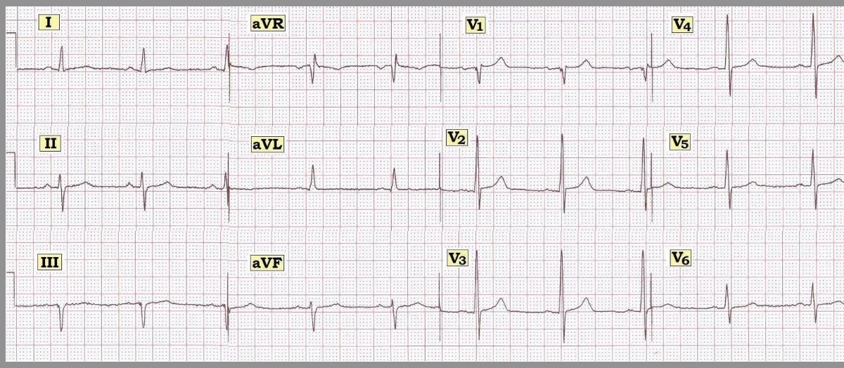 ECG Interpretation: ECG Interpretation Review #29 (Infarction ...