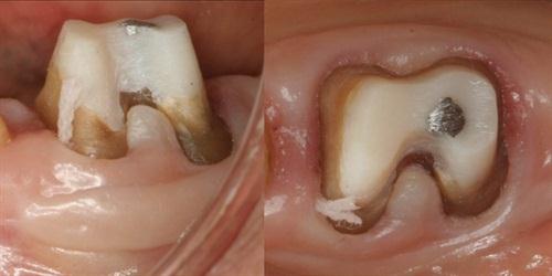 Biological shaping and barrel flute of crown - Bauer Smiles