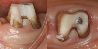 Biological shaping and barrel flute of crown - Bauer Smiles