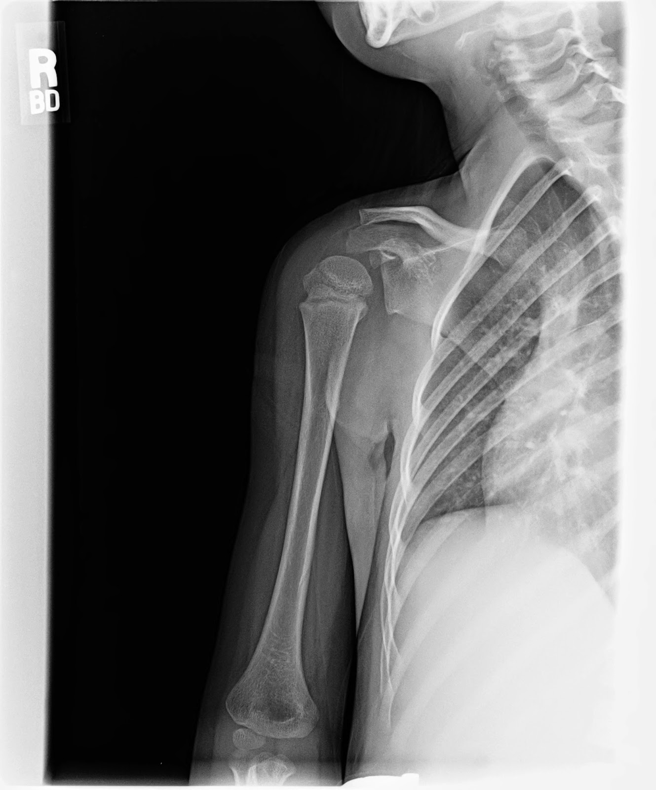 Shoulder and Elbow Surgery: The remodelling potential of the proximal ...