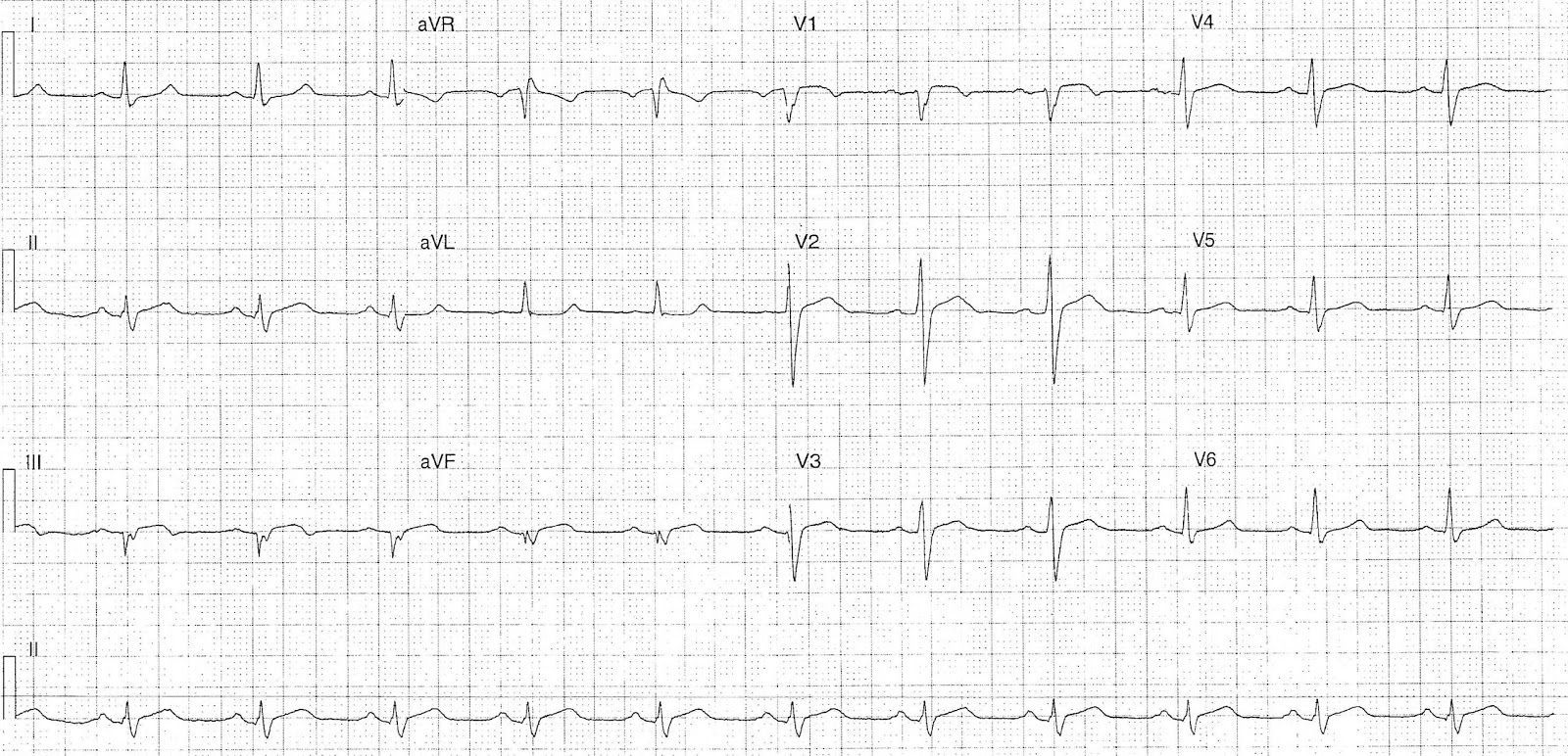 ECG of the Week: ECG of the Week - 28th March 2016 - Interpretation