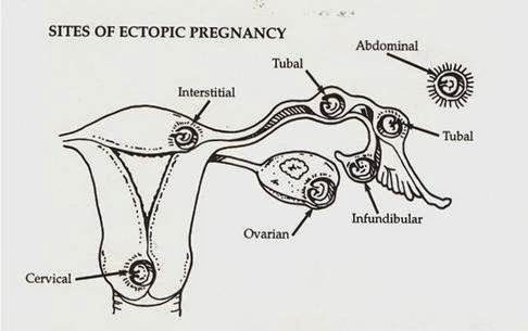 Pengobatan Herbal Kehamilan Ektopik - Eccyesis - Ectopic Pregnancy ...