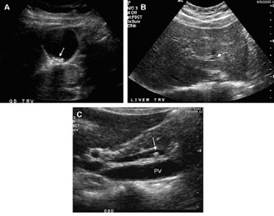 Choledocholithiasis Ultrasound - Radiology Imaging