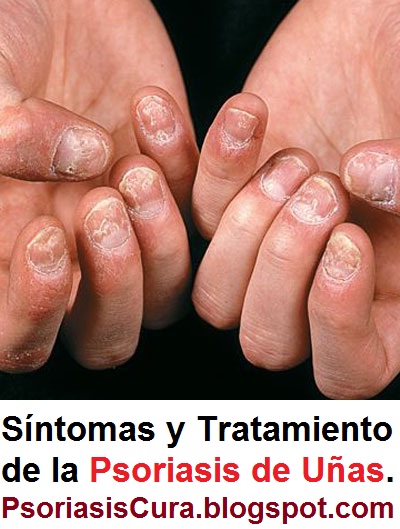 Psoriasis Cura: Psoriasis Ungueal Tratamiento Natural: Cura para ...