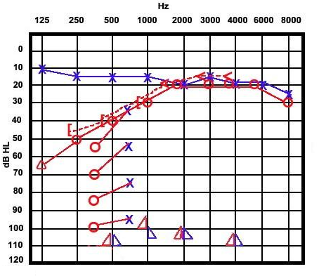 Pruebas Especiales Supraliminares para la Detección de Reclutamiento ...