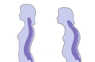scolioza cifoza spondiloza: Clasificare cifoza