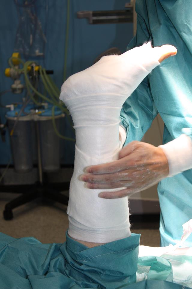 Podo Basas al Día: Matricectomía total con K-Láser Cube 4. Exostectomía ...