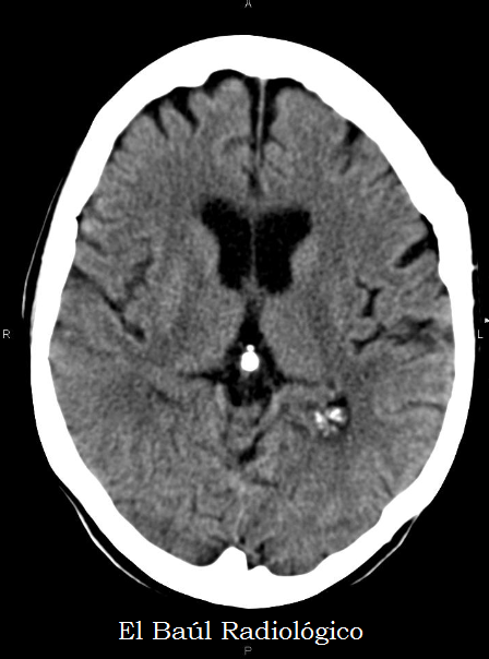 El Baúl Radiológico: OSTEOMAS CRANEALES. (Cranial Osteomas. CT Findings ...