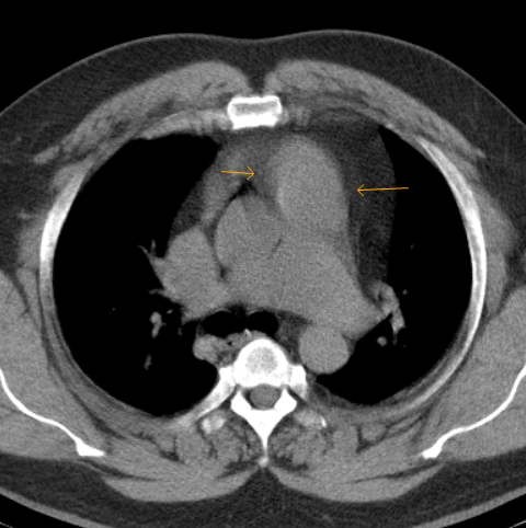 Pulmonary Artery Dilatation-CT - Sumer's Radiology Blog