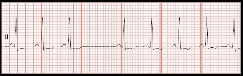 Practice EKG Rhythm Strips 145