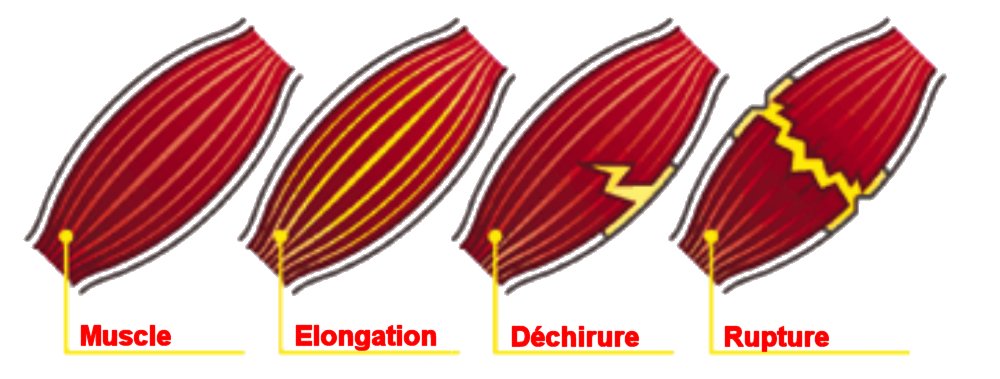 Blog 75: Infos santé : Sport et Santé-Claquage du mollet