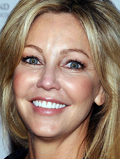 Heather Locklear Cheeks and Filler Plastic Surgery Before and After ...