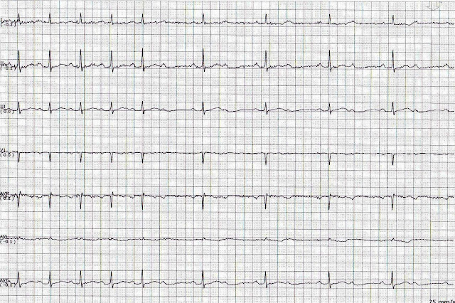 ECG Rhythms: 2:1 AV block - A subtype of Second degree AV block