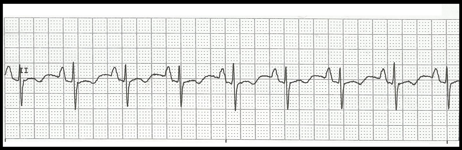 EKG Rhythm Strip Quiz 121