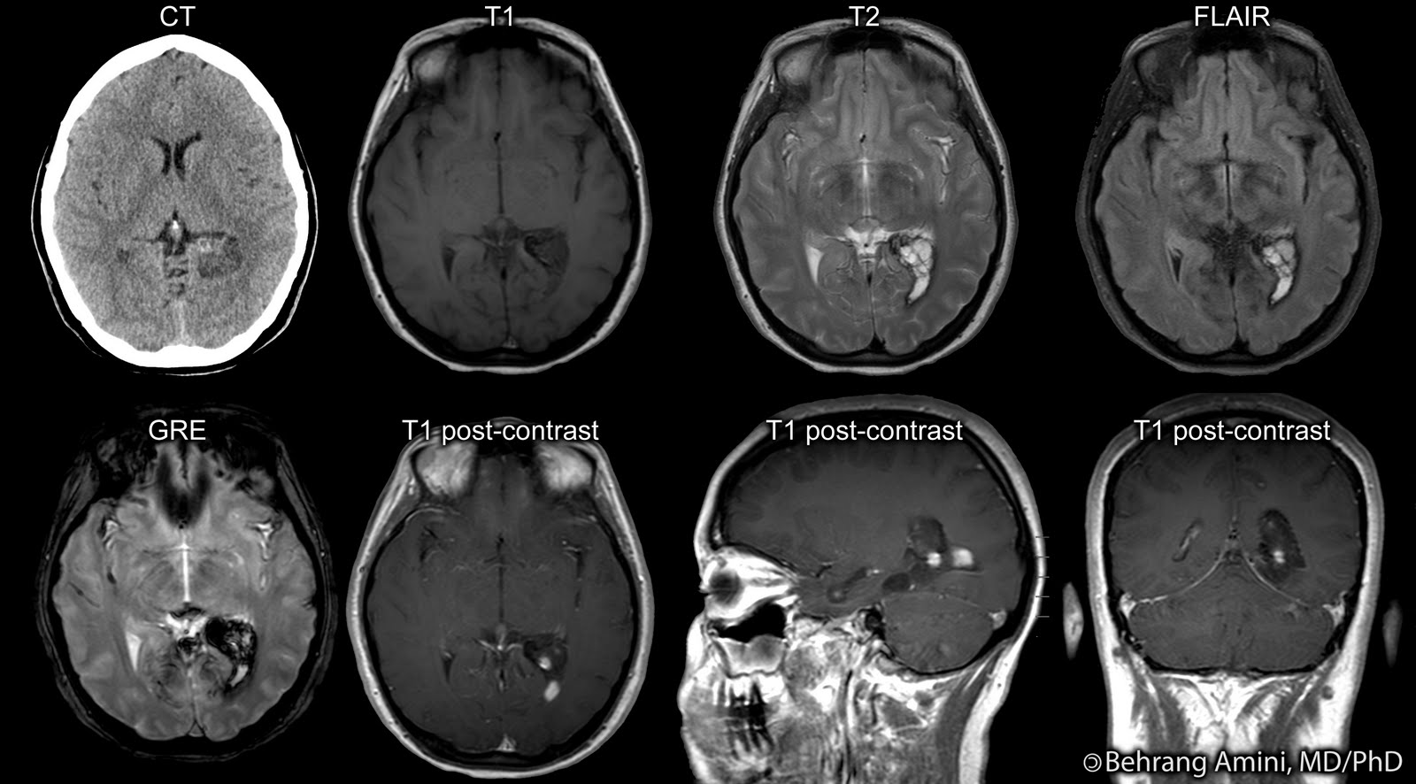 Roentgen Ray Reader: Intraventricular Oligodendrogliomas