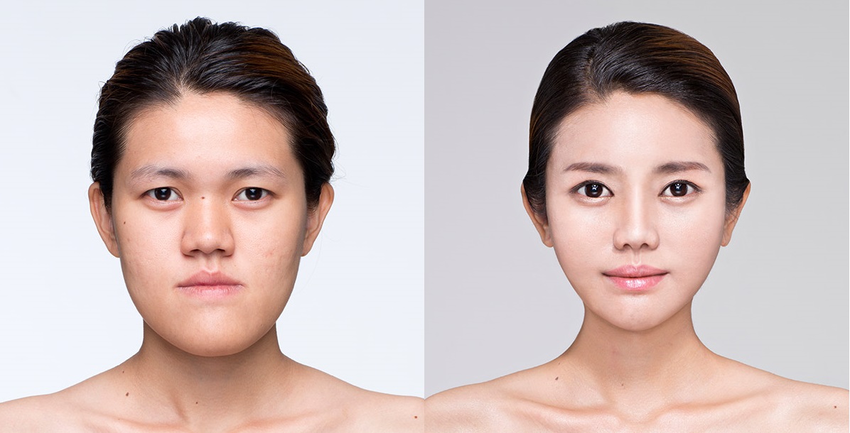 Plastic Surgery in Korea : Two jaw surgery Q&A!