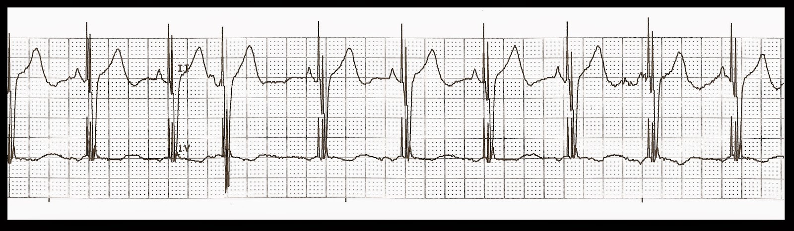 Practice EKG Strips 374