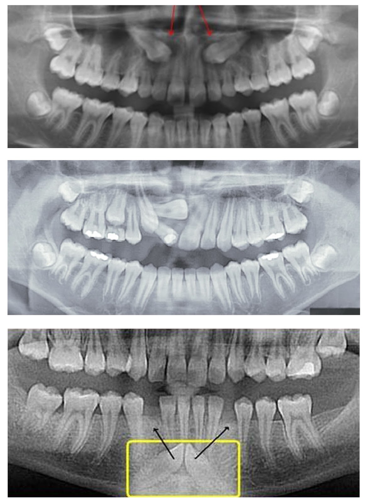 Mengenal Gigi Impaksi : Apa, Mengapa dan Bagaimana