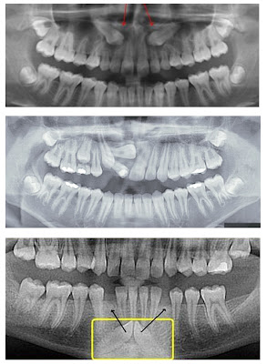 Mengenal Gigi Impaksi : Apa, Mengapa dan Bagaimana