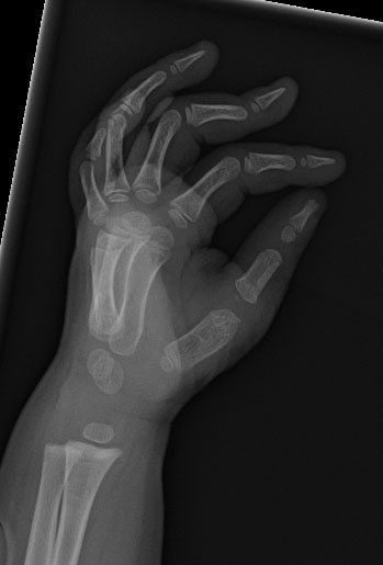 Extra Thumb | Congenital Hand and Arm Differences | Washington ...