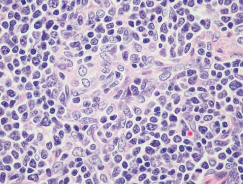 [Pathology] Atlas of Lymphocyte-Rich Spindle-Cell Thymoma (WHO Type AB ...