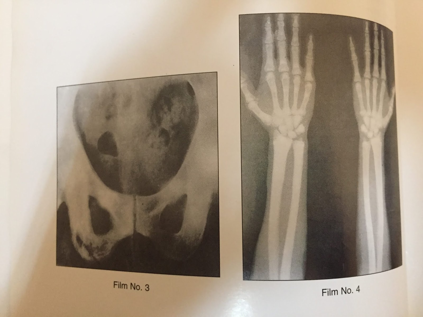 XRAYS OSTEOBLASTIC LESION OF BONE