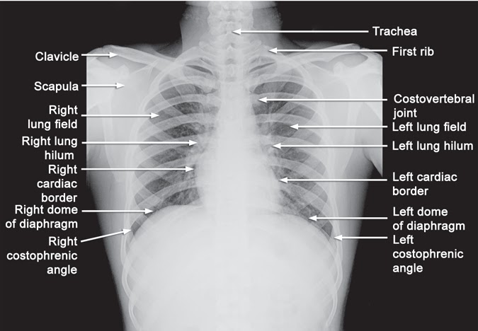 2 View Chest X Ray