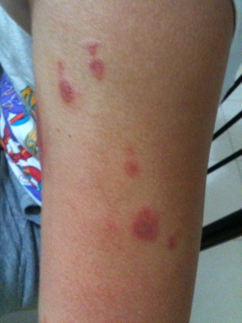 .Melissa's: Charlie / Penyakit Kulit Kumbang Rove