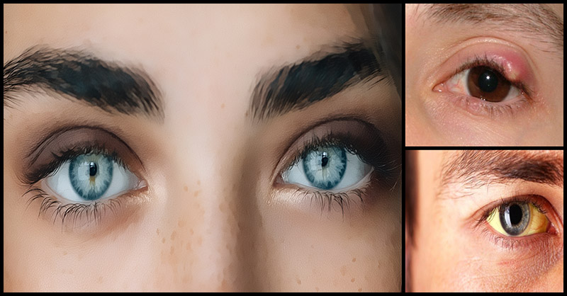 Eye Conditions That Indicate We May Have Some Unseen Health Problems ...