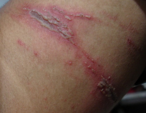 Penyakit Kulit Gigitan Tomcat, Gejala & Cara Mengatasi