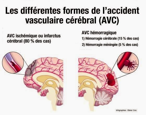 L'accident vasculaire cérébral (AVC) | Récap' IDE