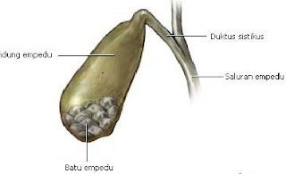 LAPORAN PENDAHULUAN KOLELITIASIS - I'm Nurse