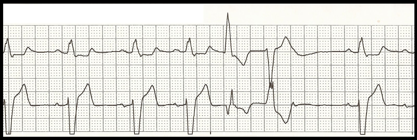 ECG Rhythm Strip Quiz 95 Ventricular ectopy