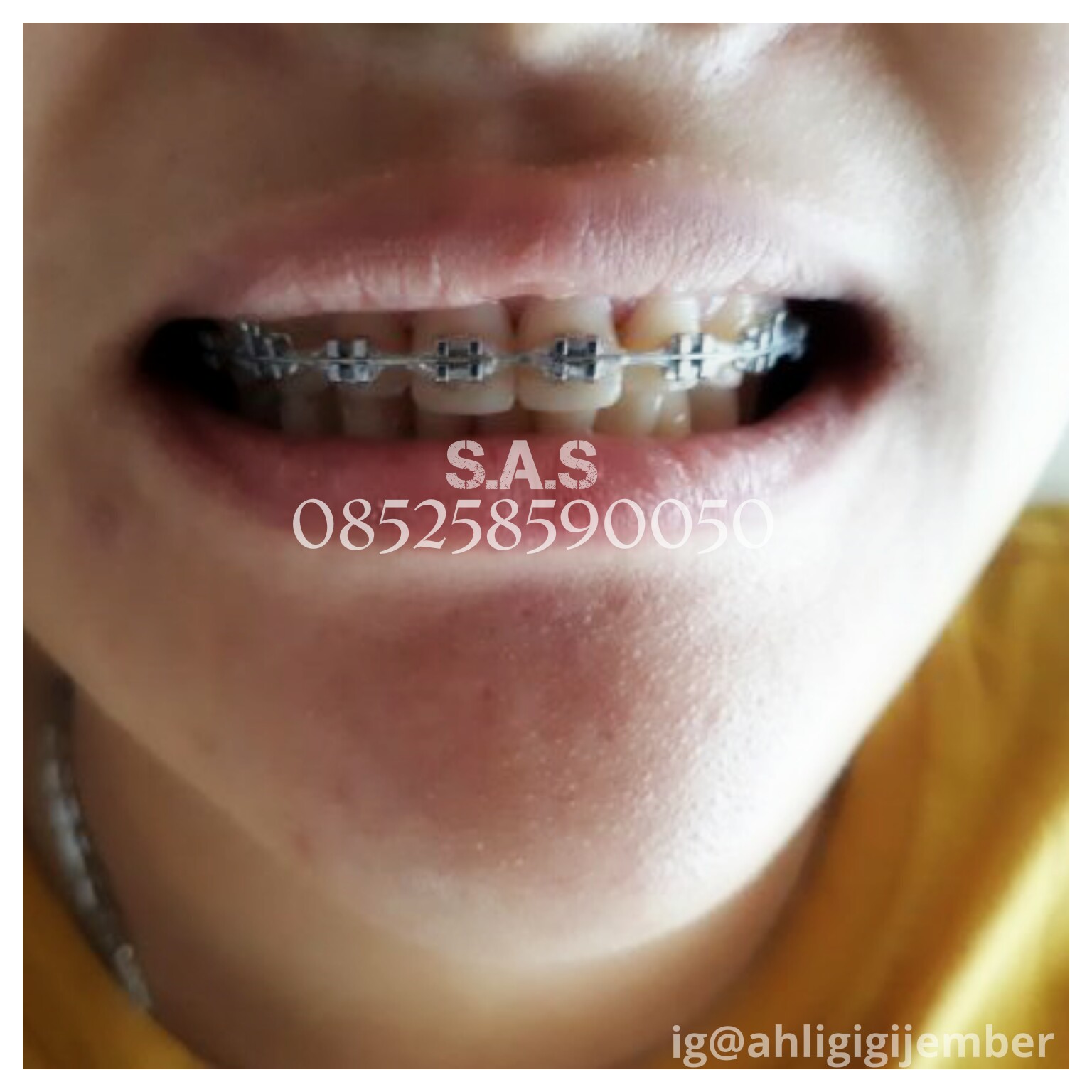 Foto Hasil Perbaikan Gigi Keropos, Berlubang Hitam Hingga Gigi Rapi dan ...