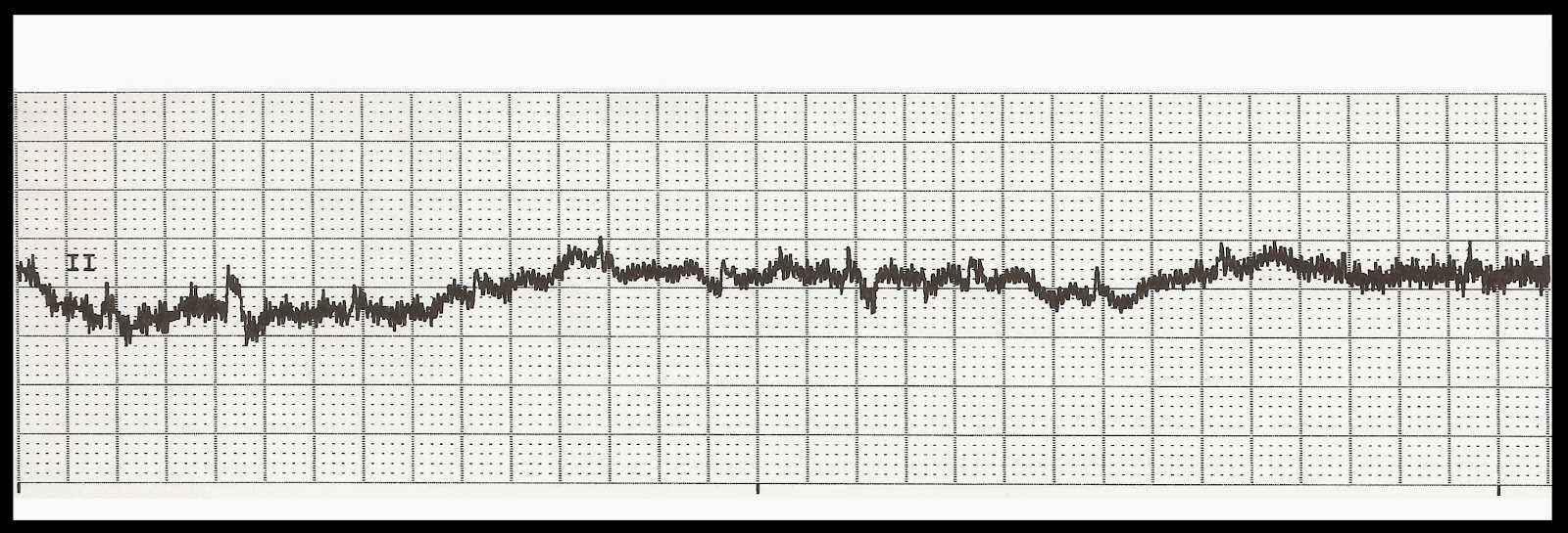 Practice EKG Rhythm Strips 224