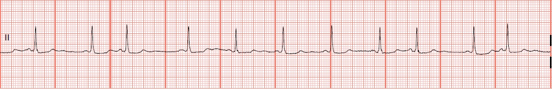 Practice ECG Rhythm Strips 106
